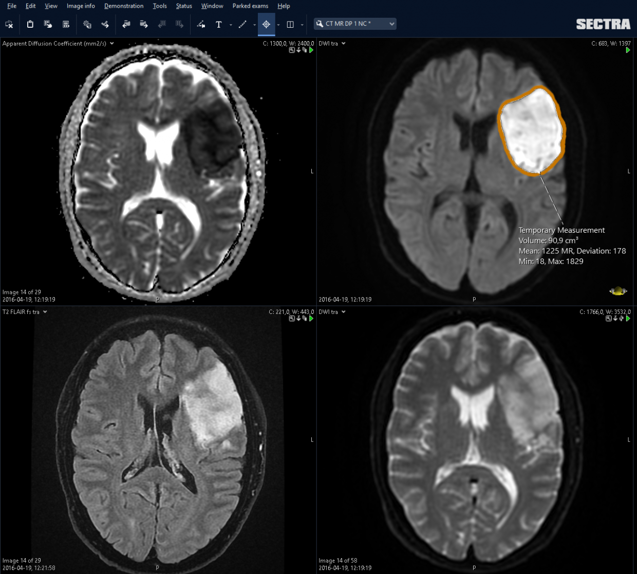 Time savings using the Sectra Volume Measurement tool | Sectra Medical