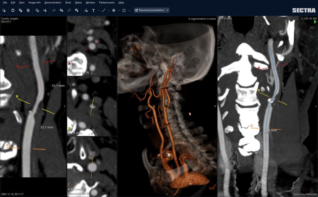 Sectra Vessel Analysis integrated in Sectra PACS | Sectra Medical